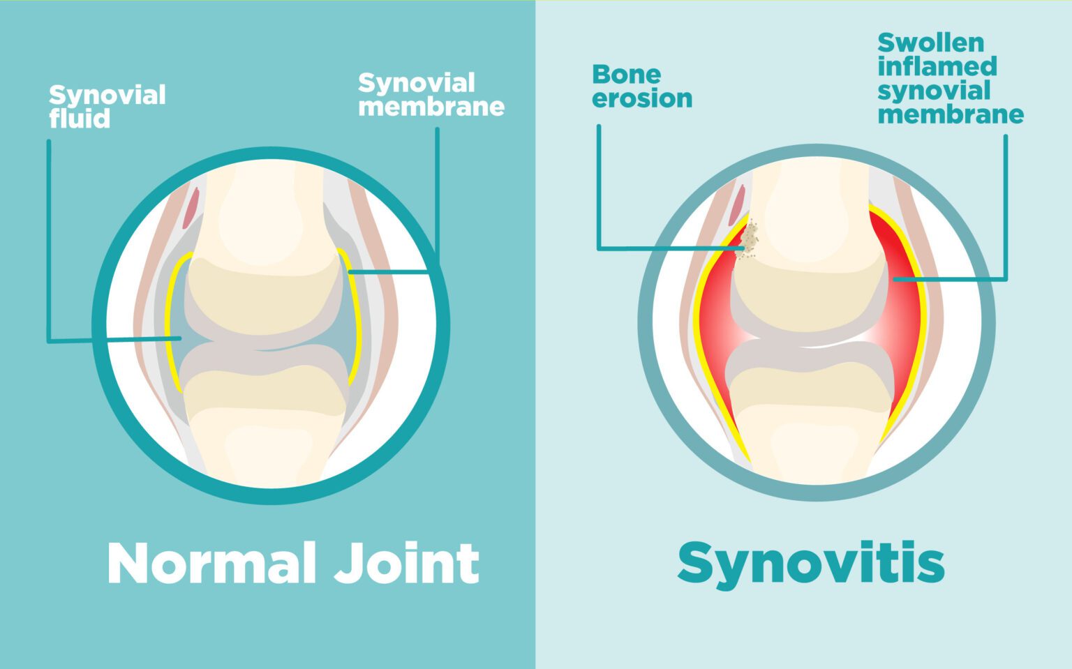 What Is Synovitis? – Posture Plus